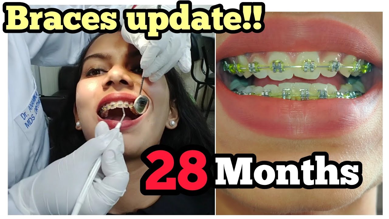 28 Months With Braces Tightening Vlog Braces Update Teeth Braces