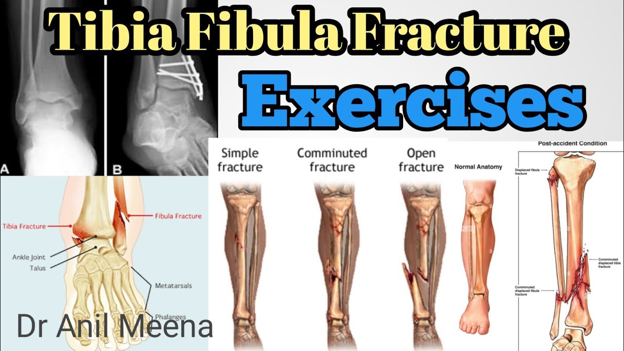 Return To Sport After Tibial Fracture At Luca Searle Blog