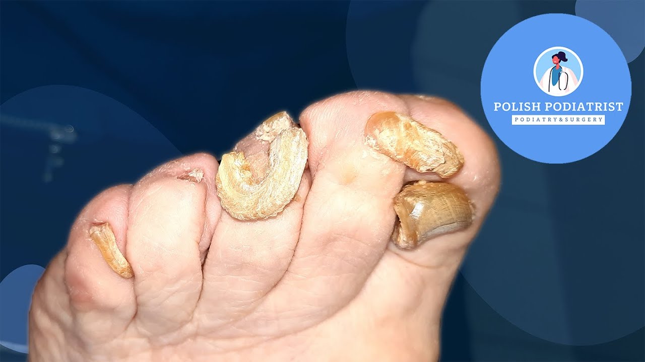 Neglected Nails Part 1 Oczyszczenie Zaniedbanych Paznokci Cz 1 Youtube