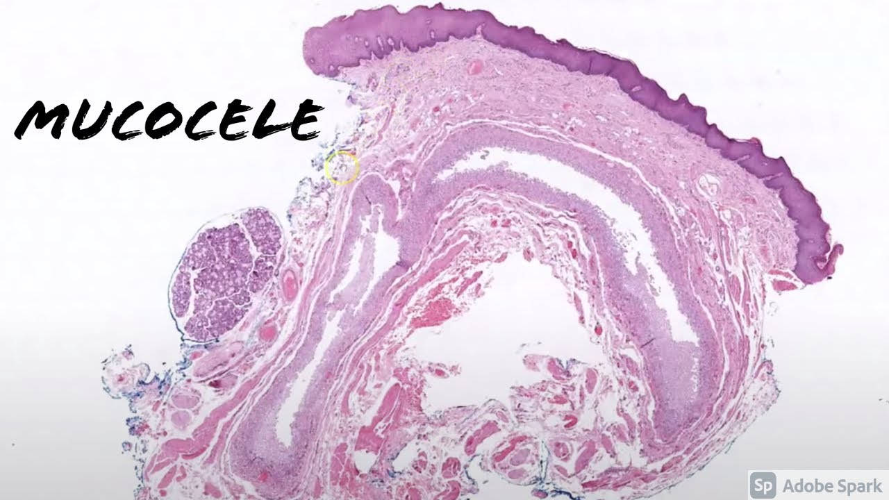 Notes On Mucocele And Mucous Retention Cystetiology