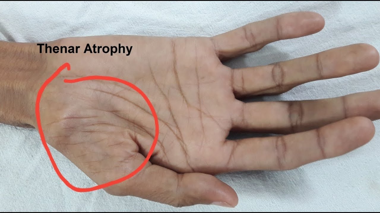 Thenar Atrophy In Motor Neuron Disease Youtube