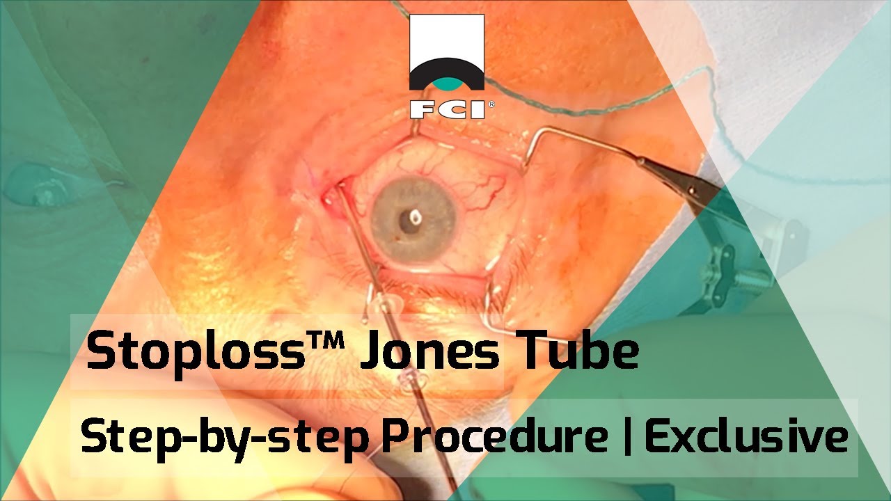 Stoploss邃 Jones Tube Cdcr Step By Step Procedure Exclusive Fci