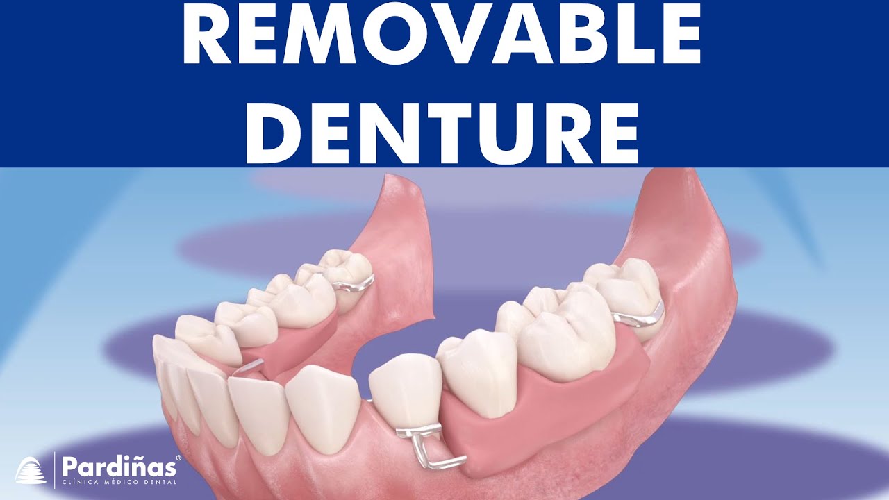 Removable Partial Denture Steps Partial Dentures Cost Types And