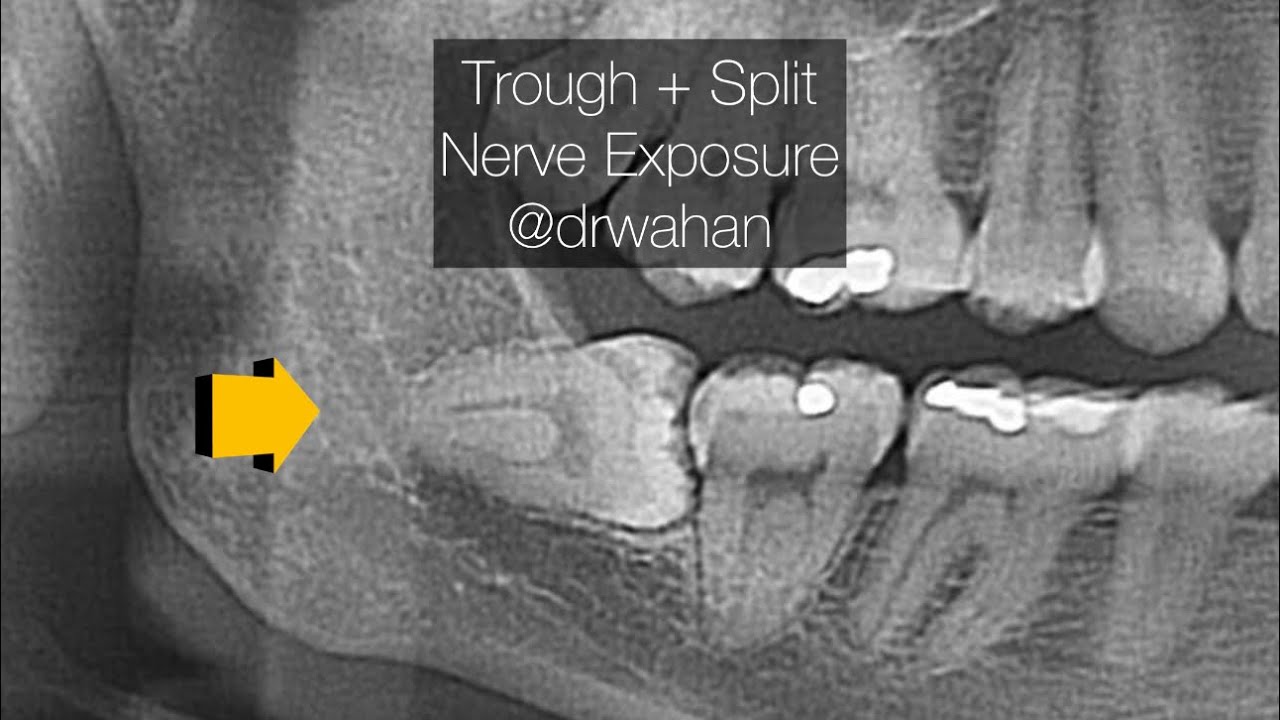 Wisdom Tooth Nerve