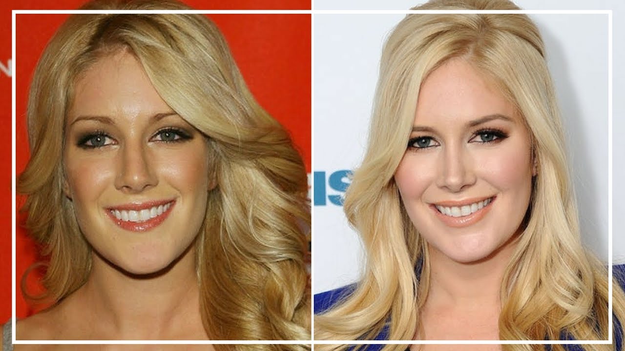 Heidi Montag Amazing Transformation Before And After Plastic Surgery