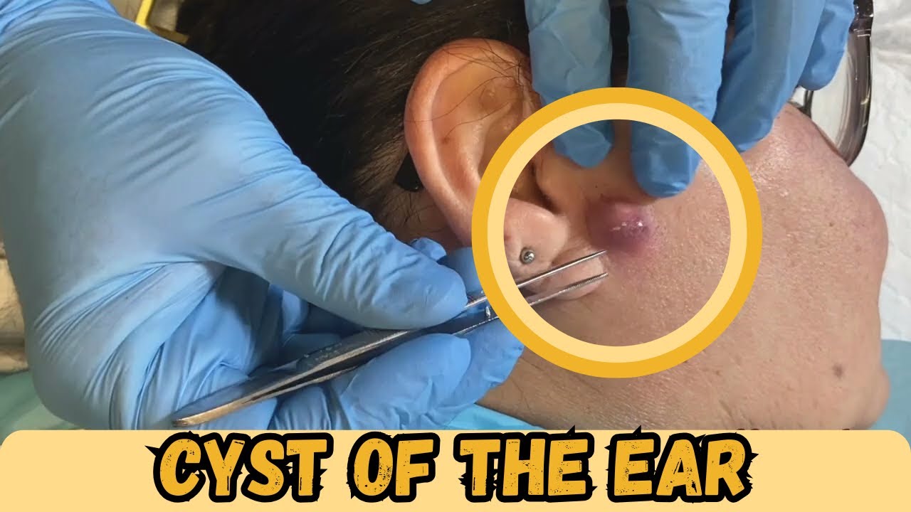 Effective Drainage Of An Infected Ear Cyst Step By Step Procedure