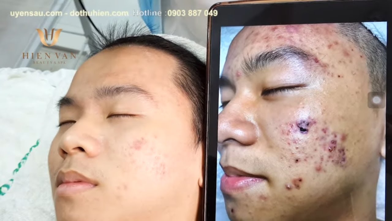 Review Khách Hàng Tại Hien Van Spa Review Client After Treatment