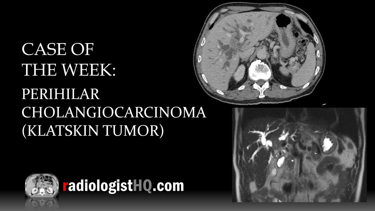 Case Of The Week Perihilar Cholangiocarcinoma Klatskin Tumor Ct Mri