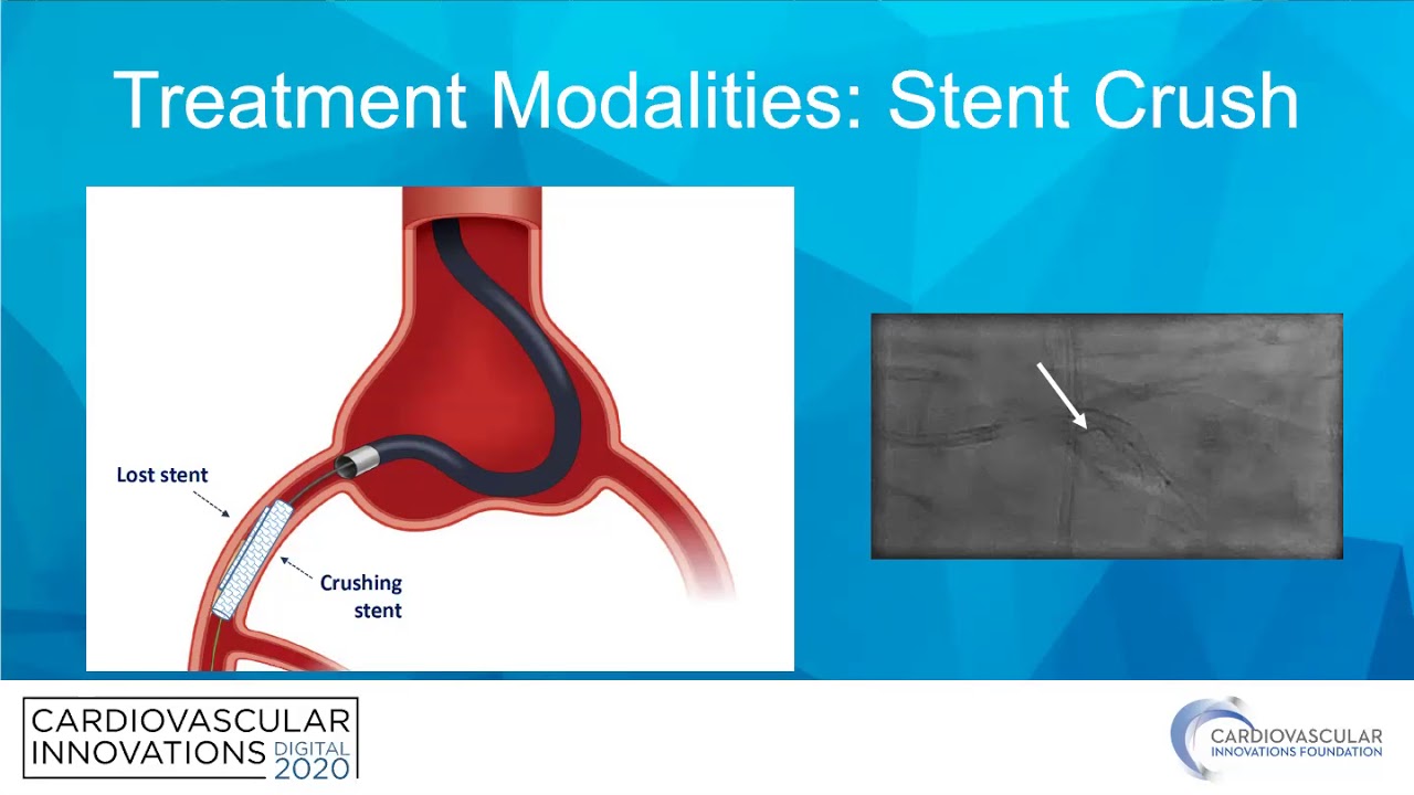 Stent Loss Algorithm Robert Riley Md Youtube