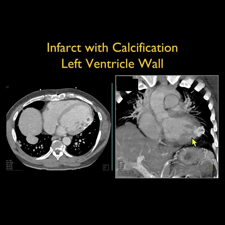 Infarct With Calcification Left Ventricle Wall Radiology Youtube