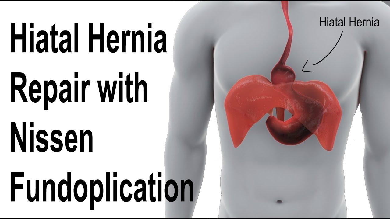 Hiatal Hernia Repair With Nissen Fundoplication To Treat Reflux