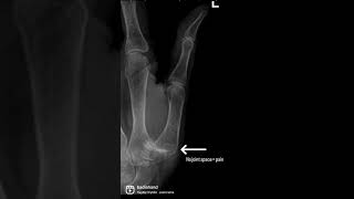 Biopro Modular Implant For Base Of The Thumb Arthritis Impressive ...