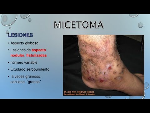 Micetoma Micologia Youtube
