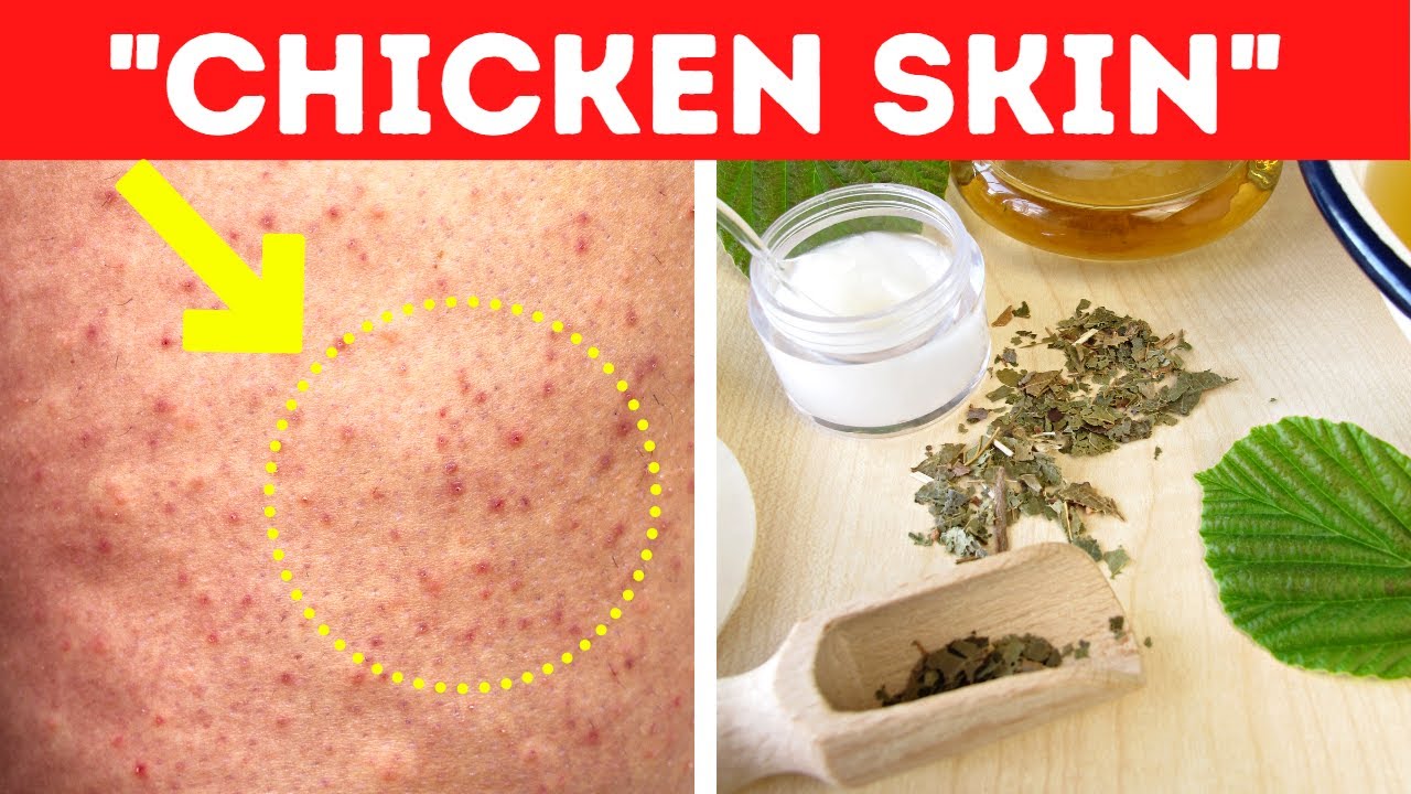 Here S How To Get Rid Of Chicken Skin Fast Keratosis Pilaris Youtube