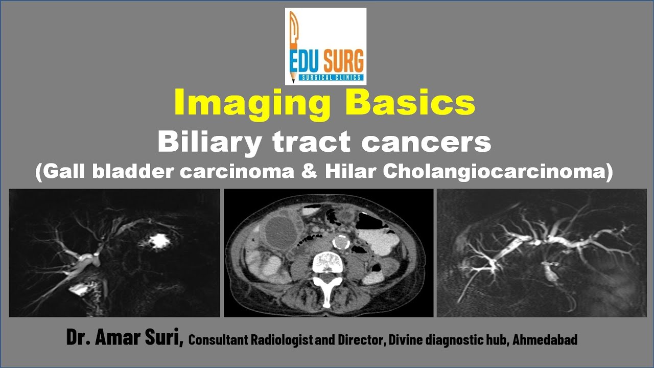Gall Bladder Cancer Hilar Cholangiocarcinoma Radiology Masterclass