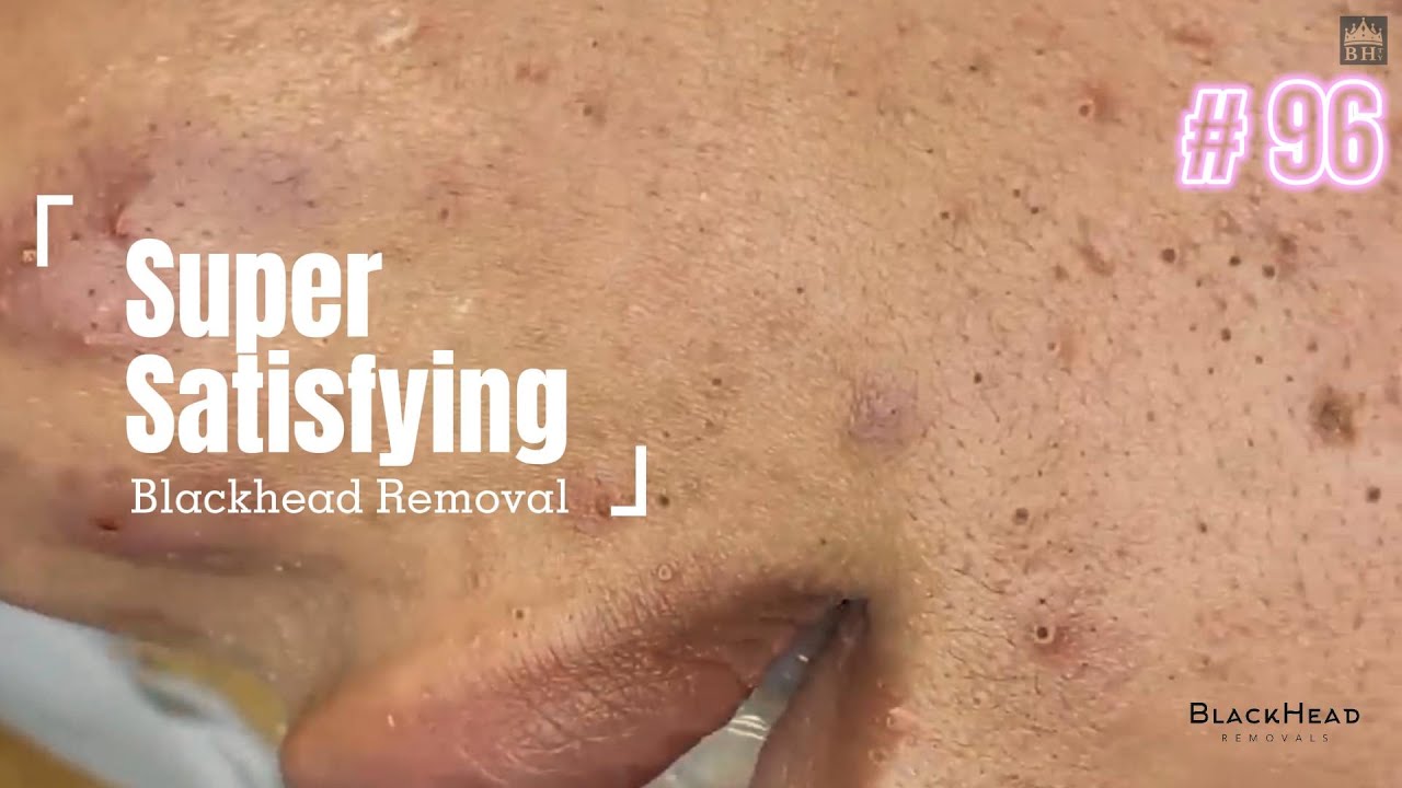 Super Satisfying Blackhead Removal Youtube
