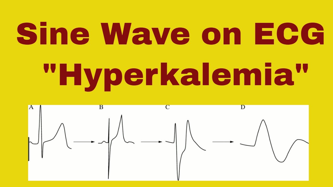 Hyperkalemia Ecg Sine Wave