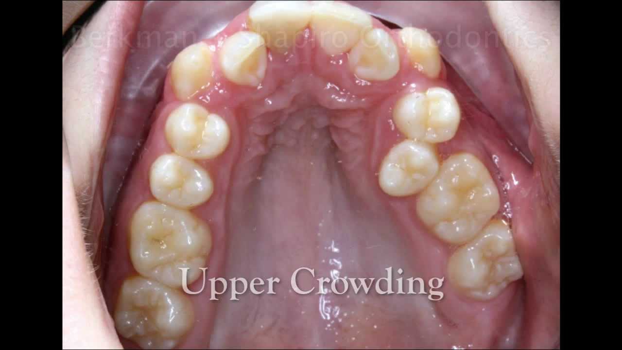 Gapped Teeth Before And After Braces Mainsnap