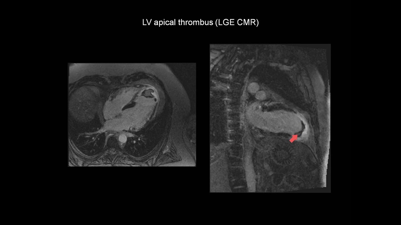 Lv Thrombus Uptodate Semashow