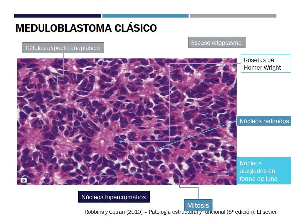Meduloblastoma Youtube