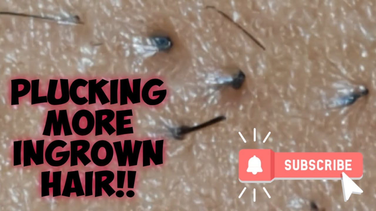 Hair Ingrown Removal Satisfying Youtube