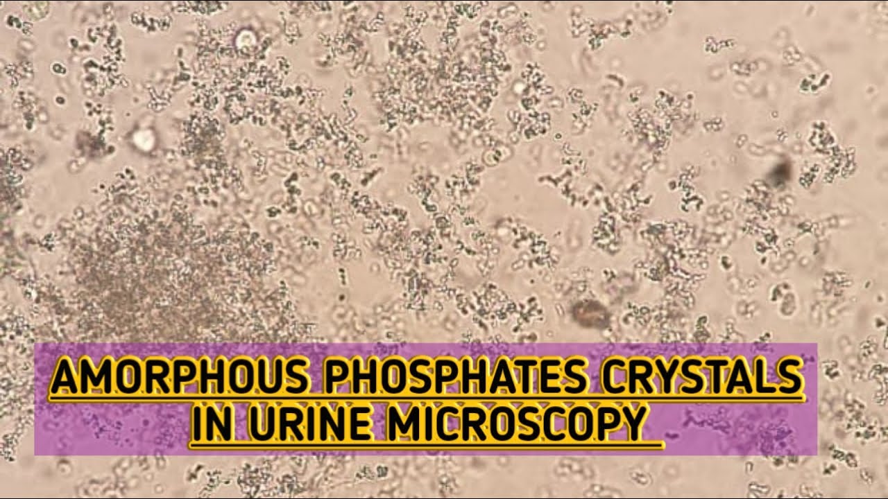 Amorphous Crystals In Urine Normal Range At Jessica Owens Blog