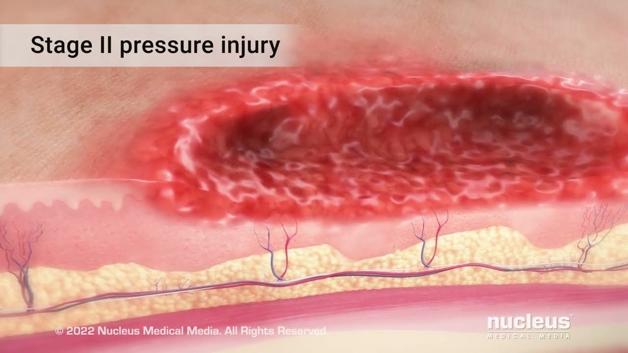 Deep Tissue Injury Spotting The Hidden Danger Photos Guide