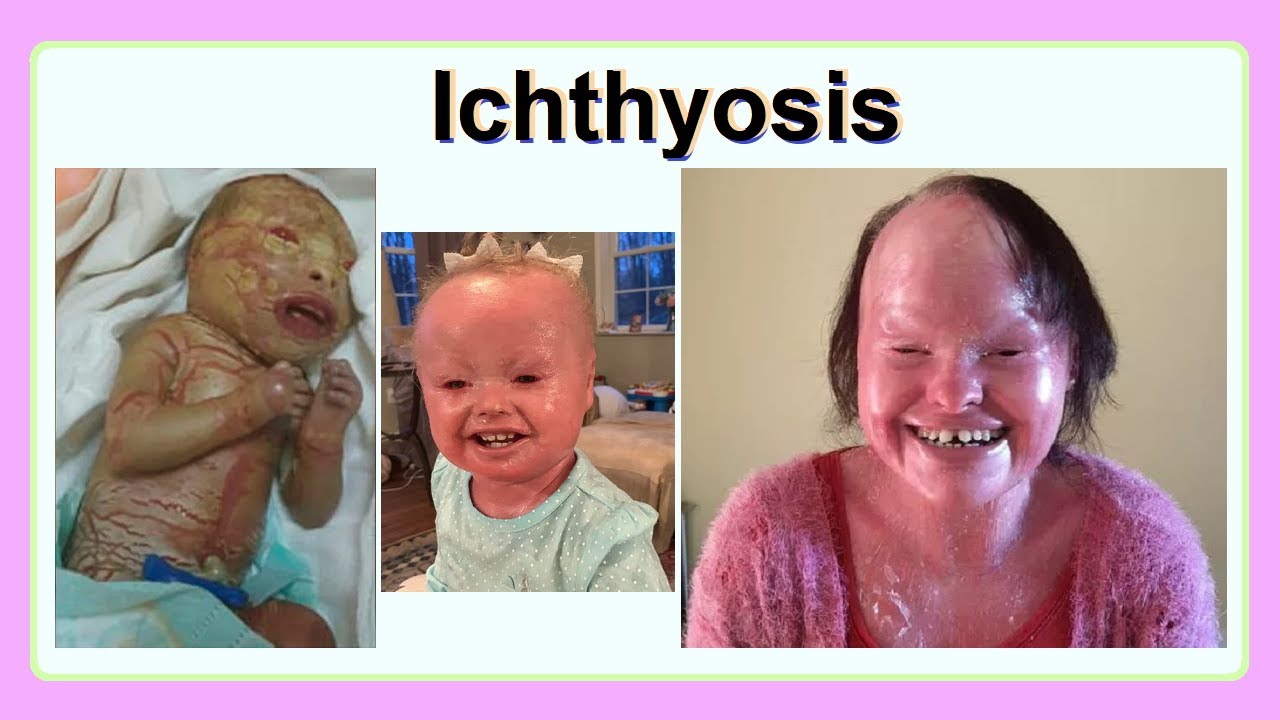 Ichthyosis Vulgaris Face