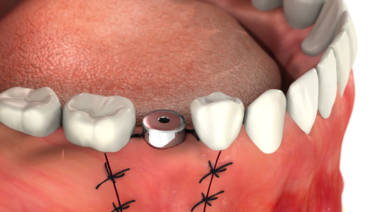 Dental Implant Abutment