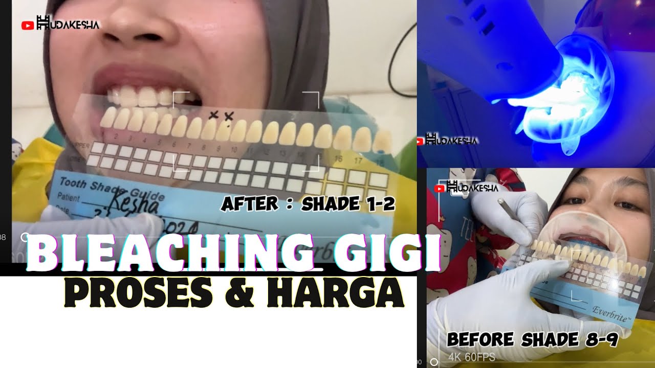Bleaching Gigi Full Review Harga Bleaching Gigi Youtube