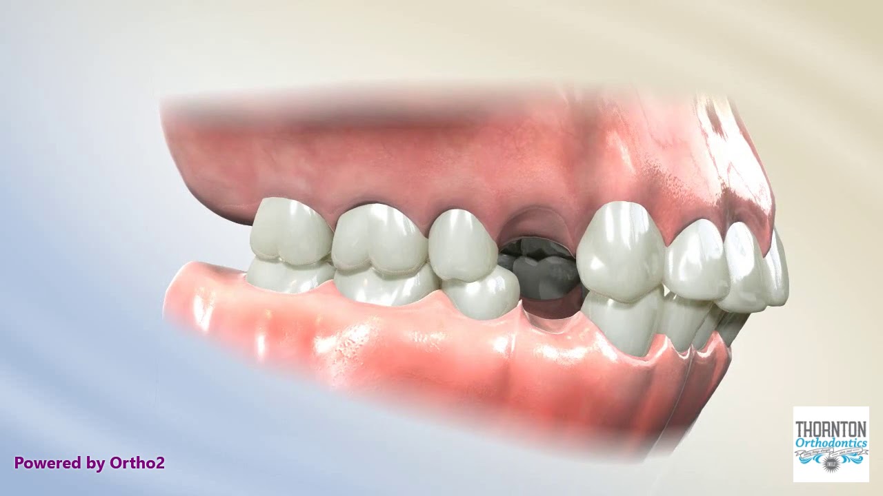 Premolar Extraction Guidelines First Permanent Molars Orthodontics Hysk