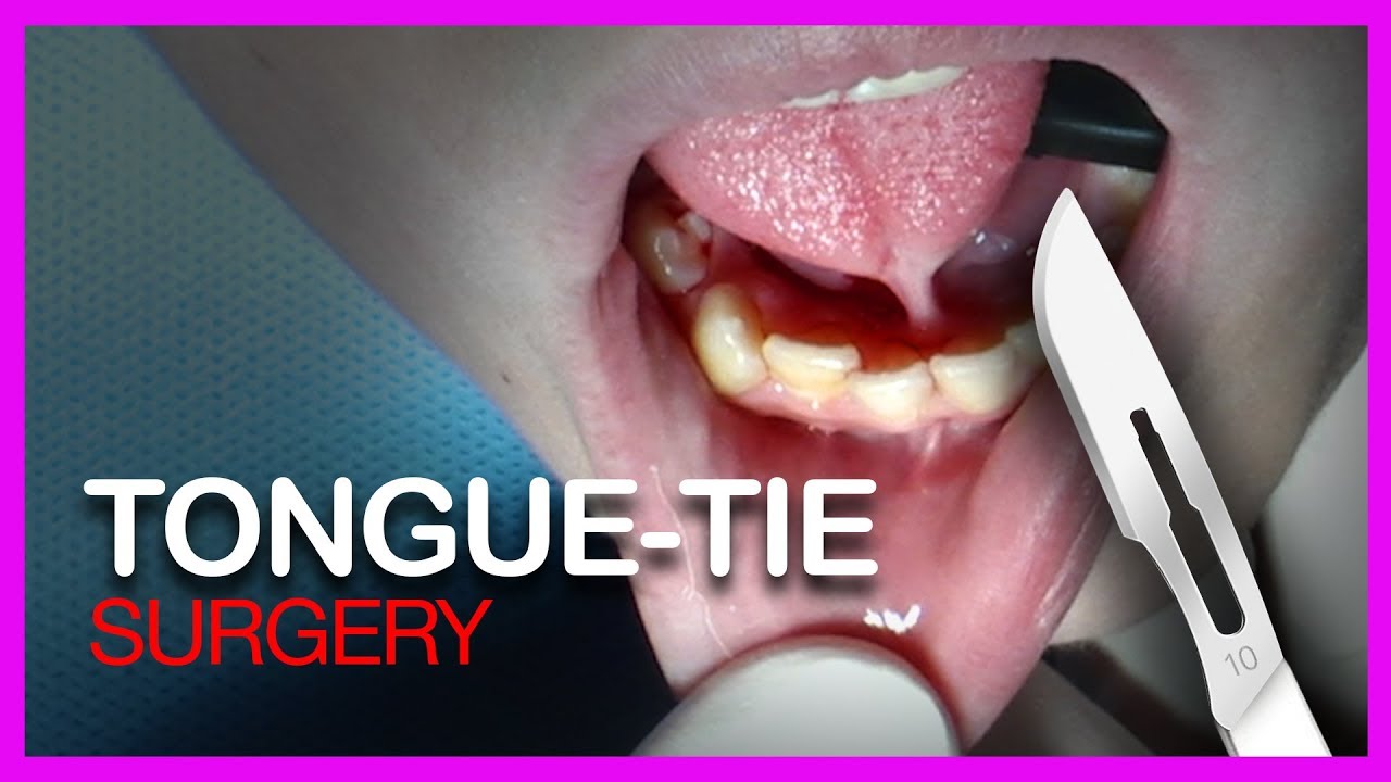 What Is A Tongue Tie Release Procedure Infoupdate Org