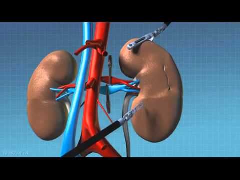 Davinci Robotic Surgical System Partial Nephrectomy Animation Youtube