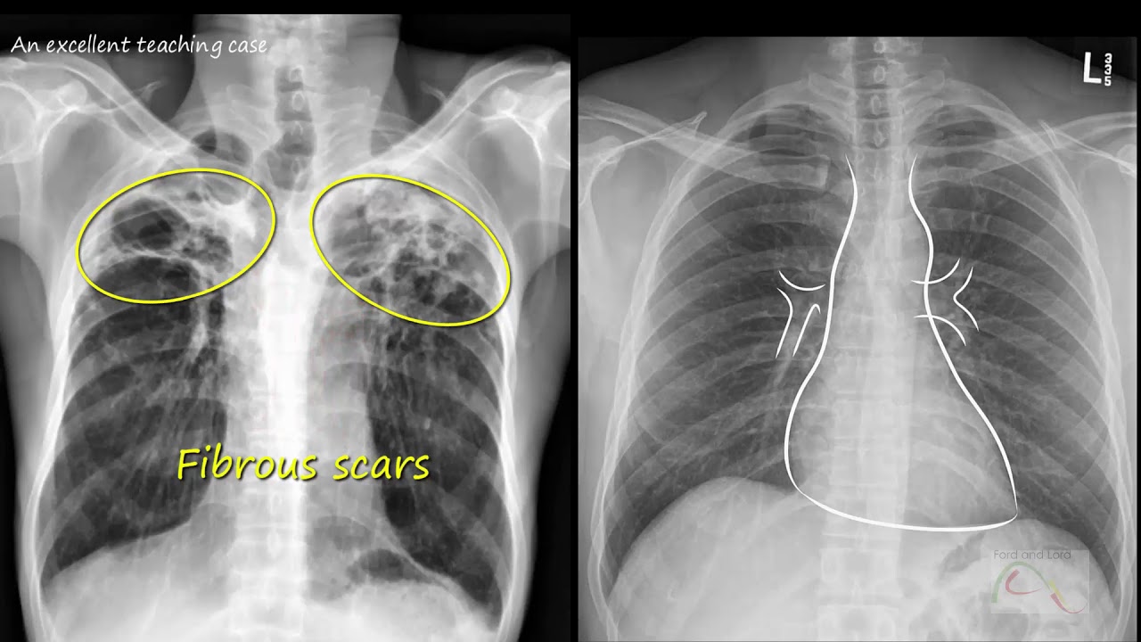 Tuberculosis Lung X Ray The Radiology Assistant Imaging Findings In