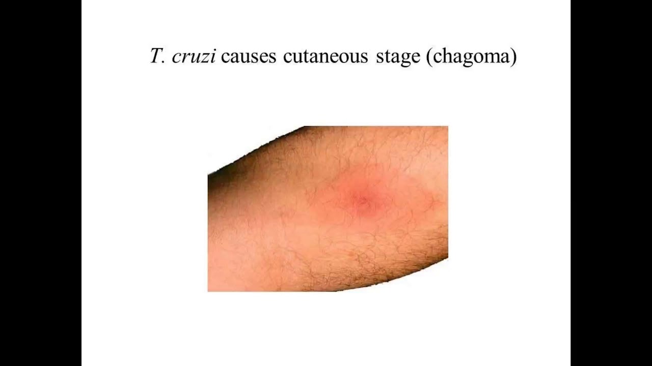 Chagas Disease Causes Symptoms Diagnosis Treatment Pathology Youtube