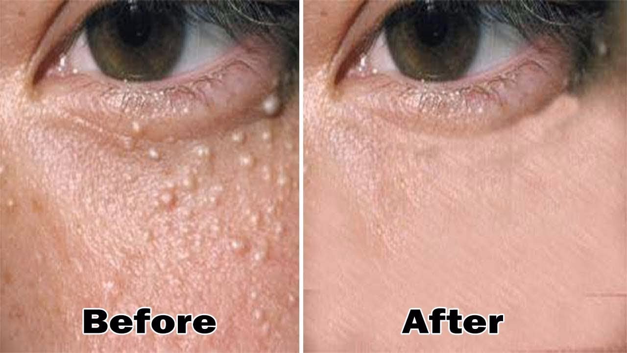 Milia Treatment 3 Weeks To Remove Milia And White Bumps Under Eyes By