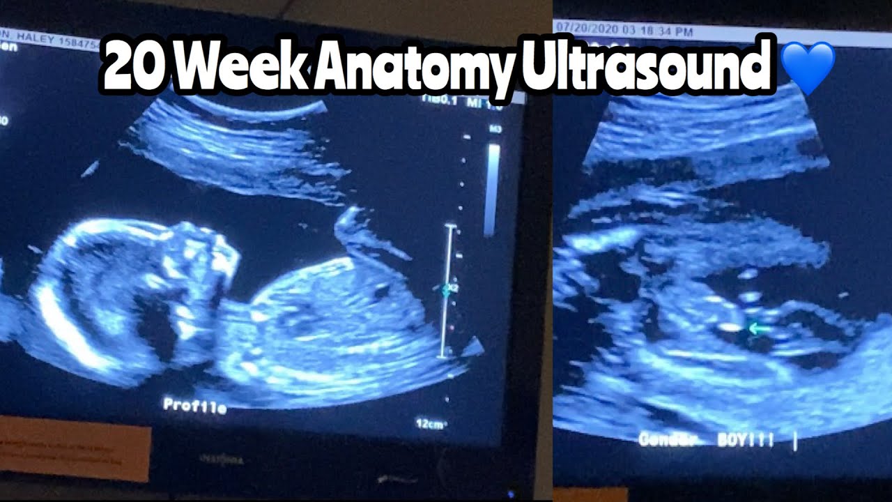 20 Week Ultrasound Anatomy Scan 20weekultrasound Youtube