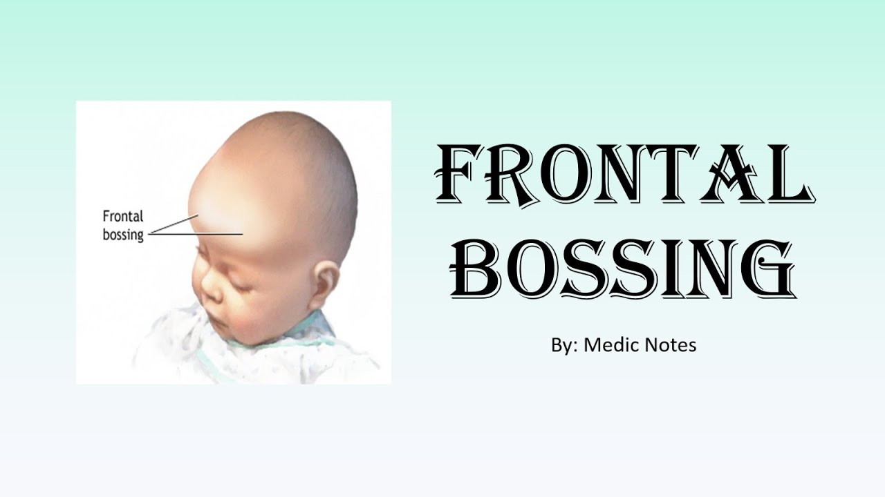 Frontal Bossing Acromegaly