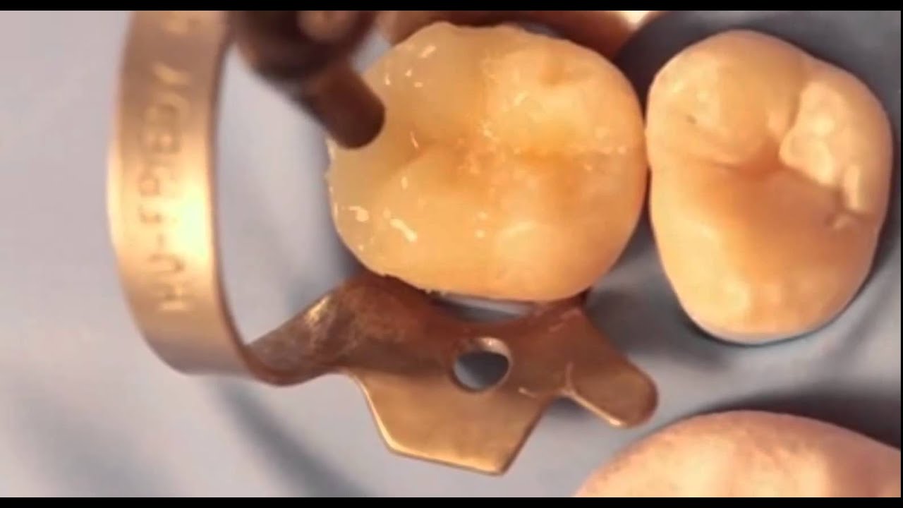 Building Cusps With Composite Resin By Dr Lincoln Harris Youtube