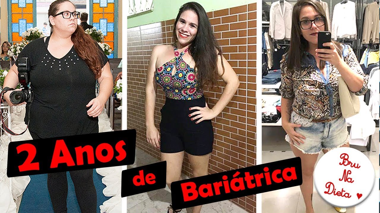 Bypass Gastrico Antes E Depois
