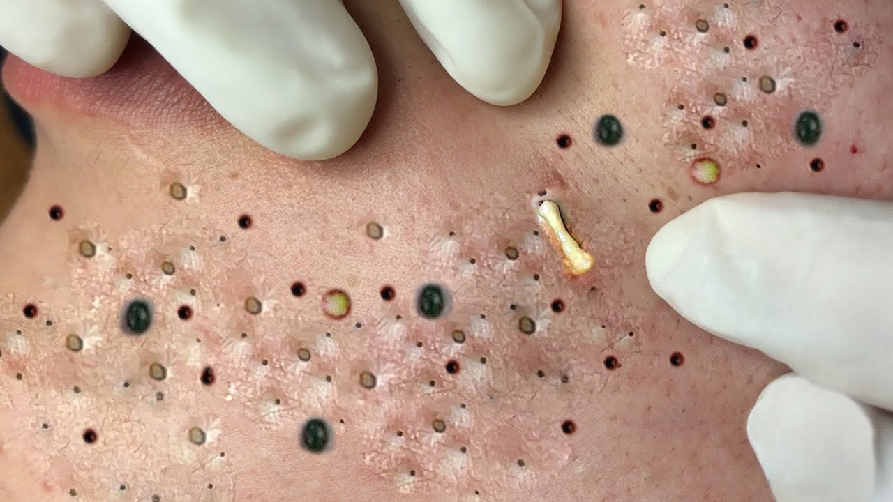 Make Your Acne Treatment Acne Spa 270 Sac Dep Spa Youtube