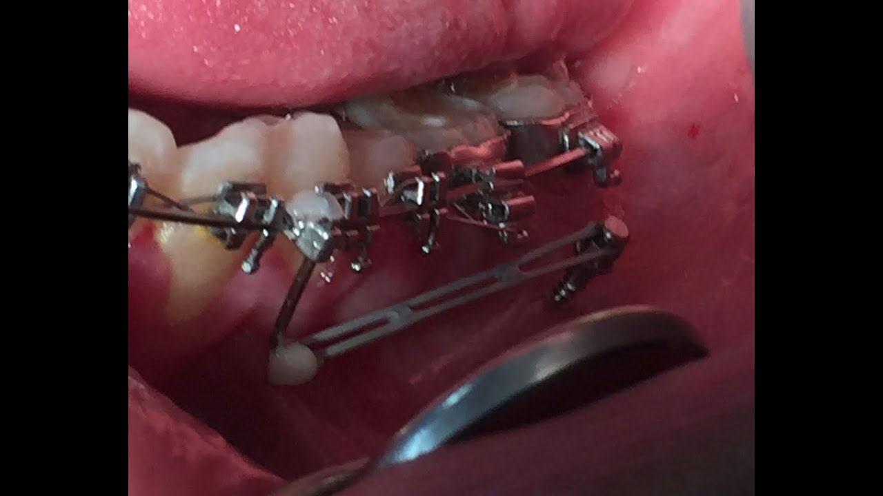 Importance Of Buccal Shelf At Phyllis Lange Blog