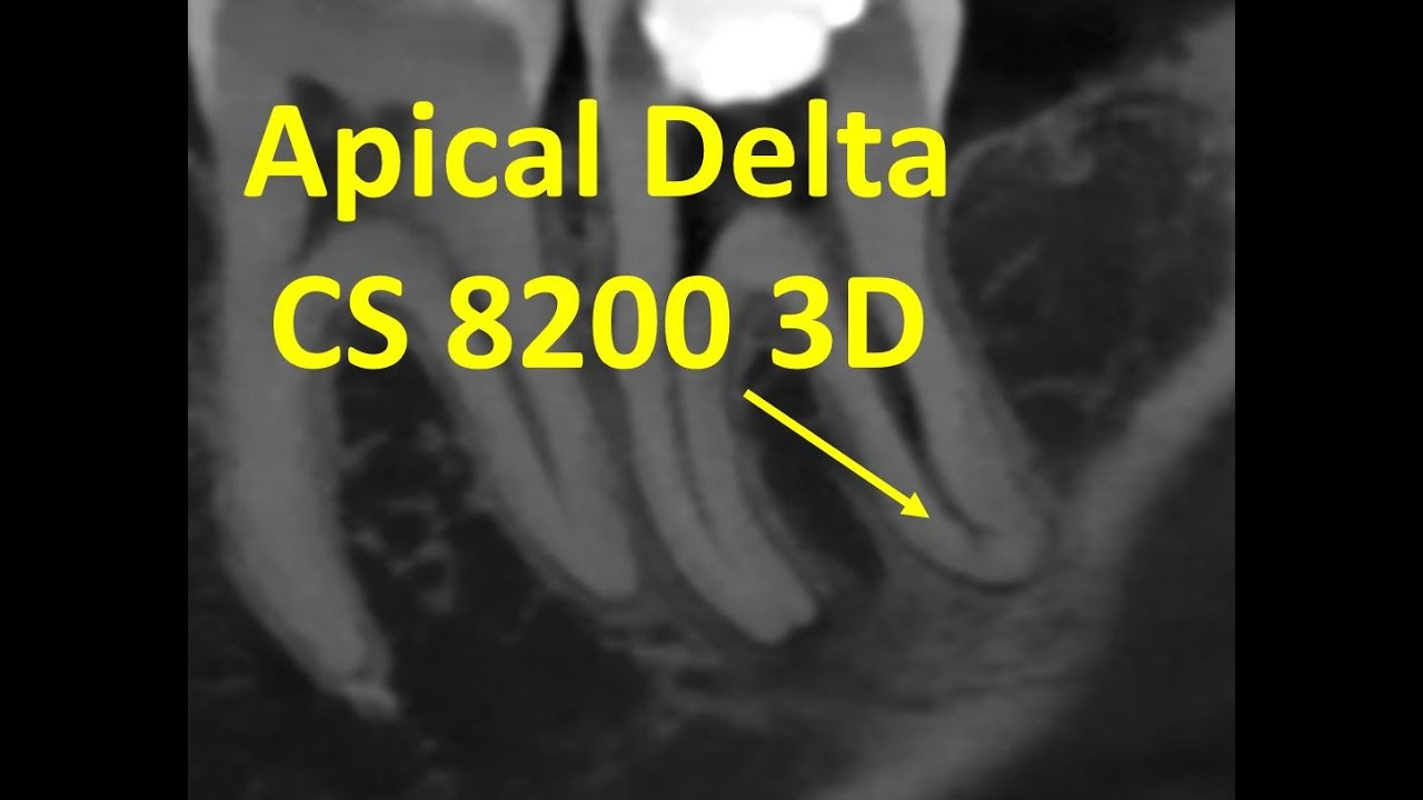Cs 3d Imaging Apical Delta Youtube