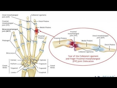Hand Fracture Dislocated Interphalangeal Joint