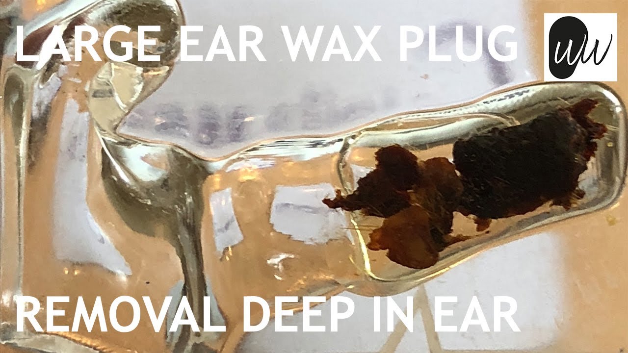 Cleaning Out Impacted Ear Wax