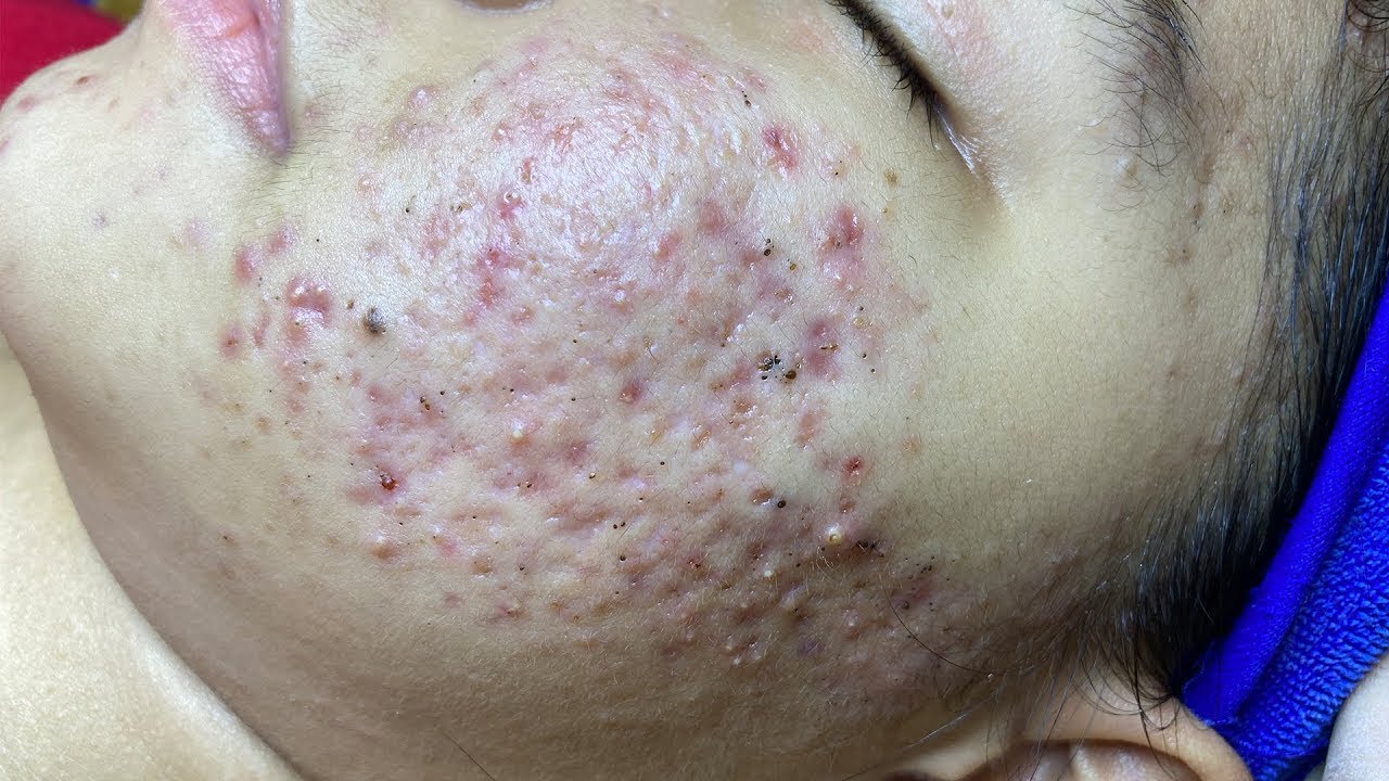 Make Your Acne Treatment Acne Spa 136 Sac Dep Spa Youtube