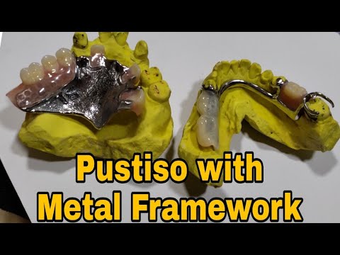 Dentures With Metal Framework Cast Partial Dentures By Datuambastv