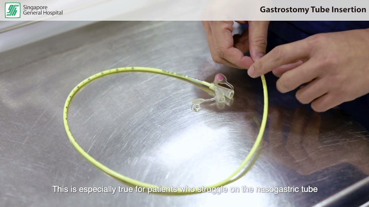 All About Percutaneous Radiological Guided Gastrostomy Insertion Youtube