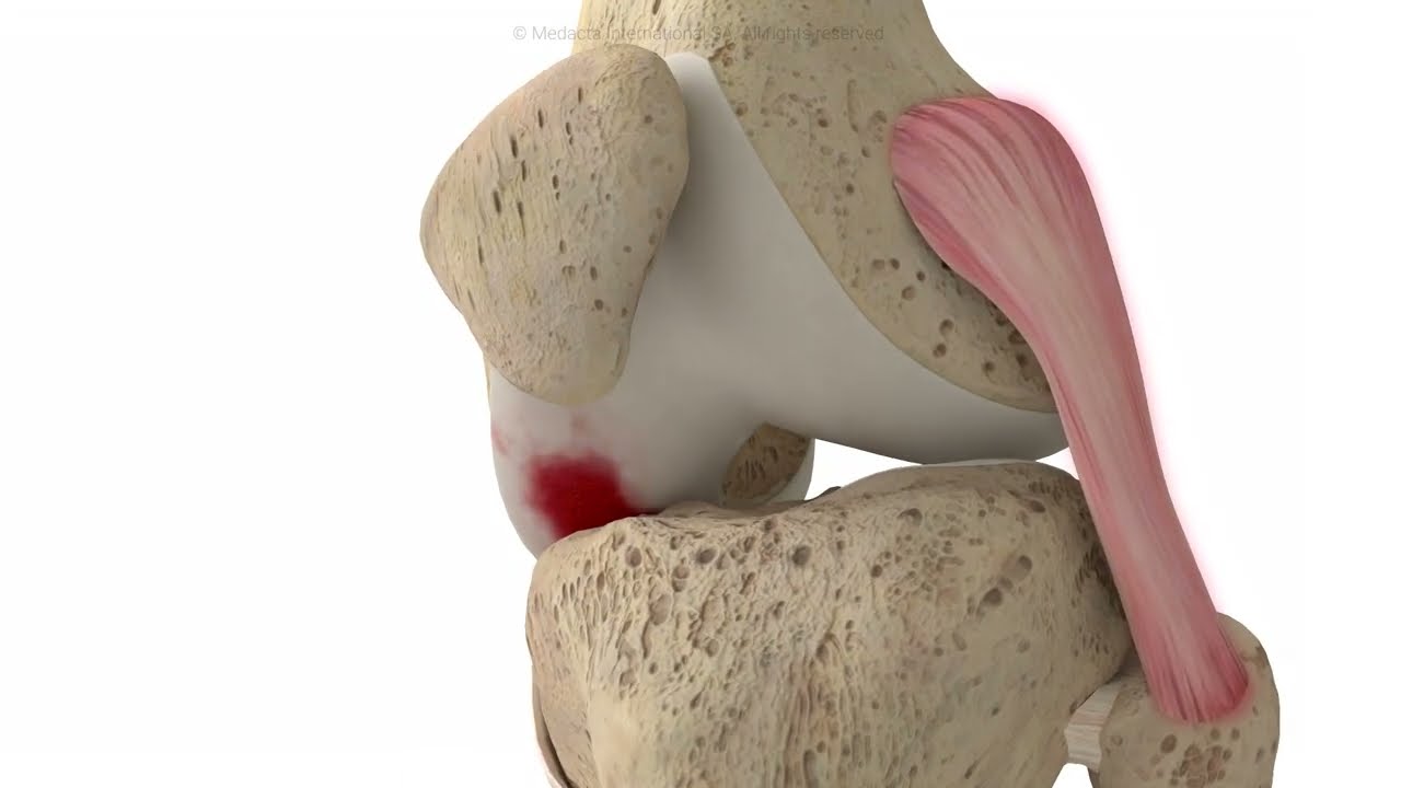 Kinematic Alignment Salt Lake City Total Knee Arthroplasty Ogden Ut