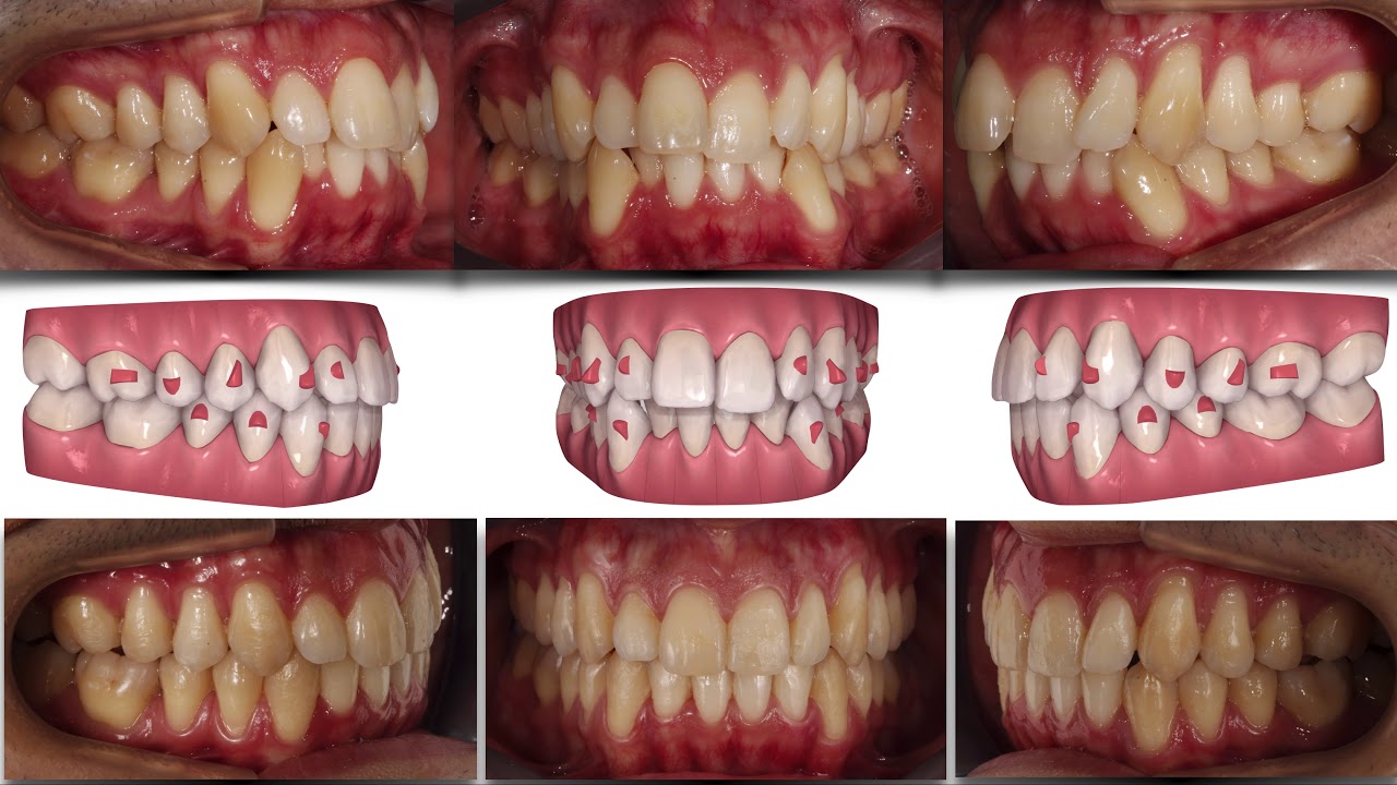 How Does Invisalign Work For Crowded Teeth At Maria Elsberry Blog